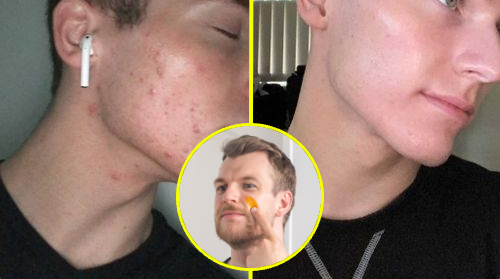 TOP 5 MEN’S SKINCARE PRODUCTS FOR REMOVING ACNE – Modern Man Daily